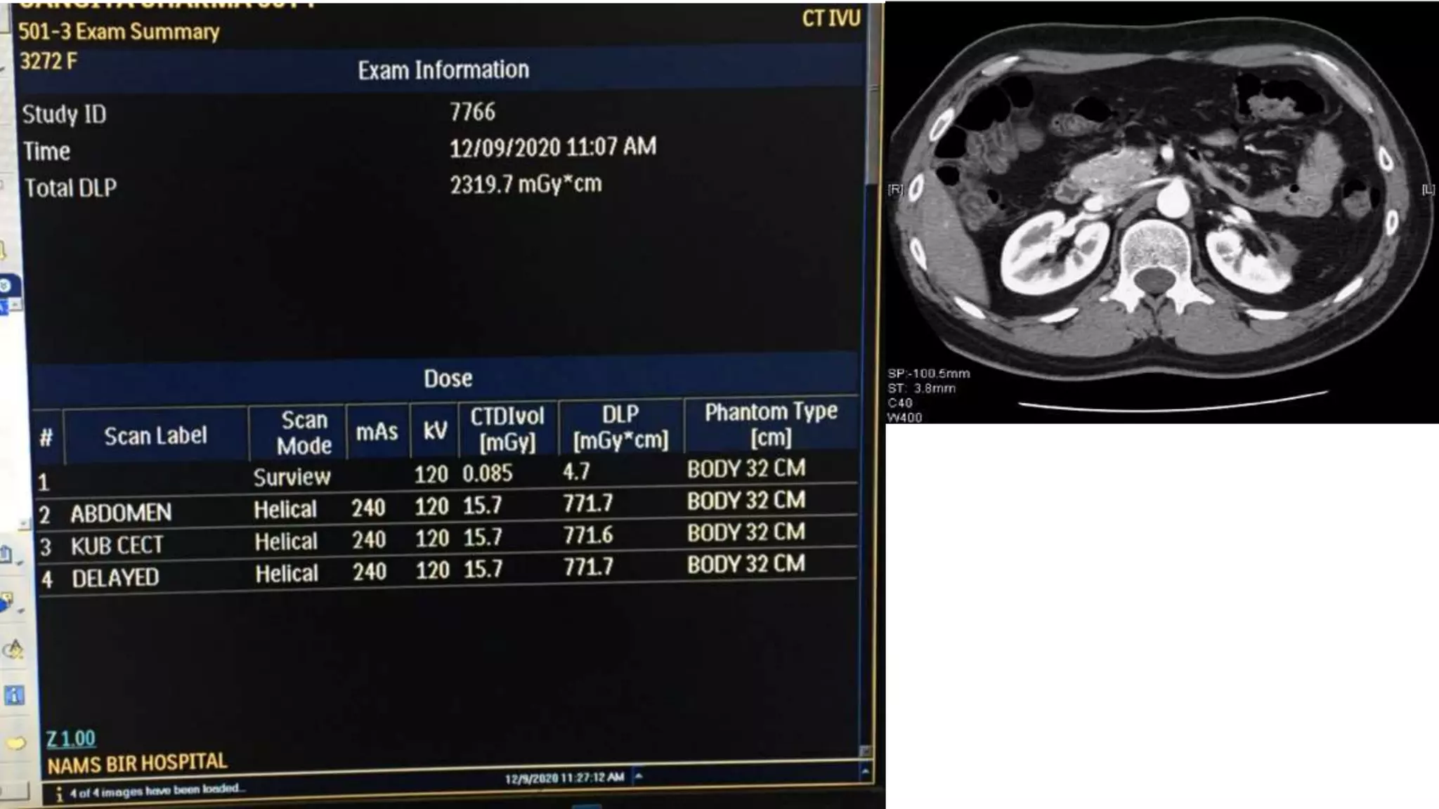 Computed Tomography Dose Index | PPTX
