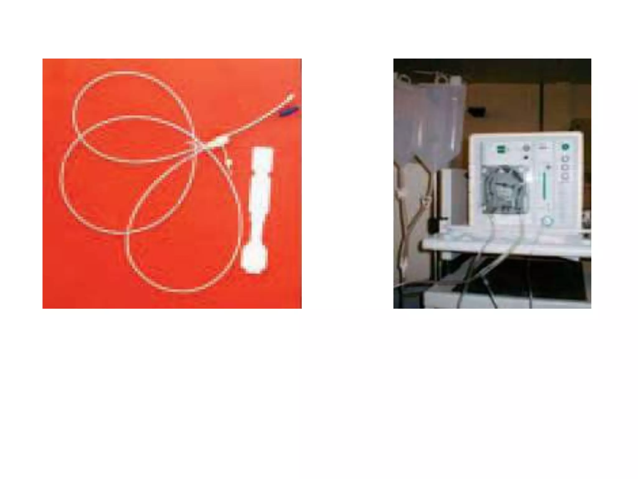 CT Enteroclysis | PPTX