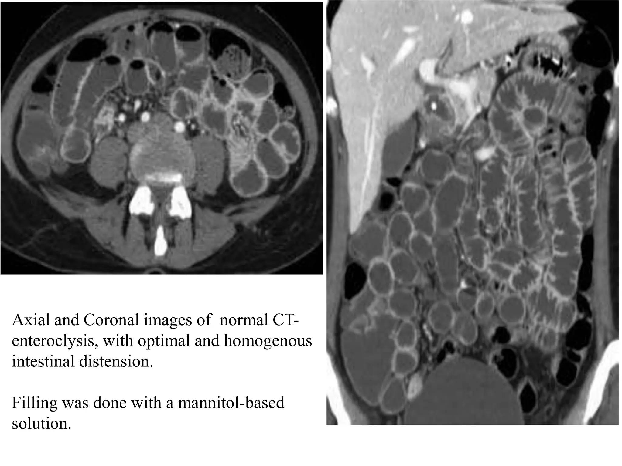 CT Enteroclysis | PPTX