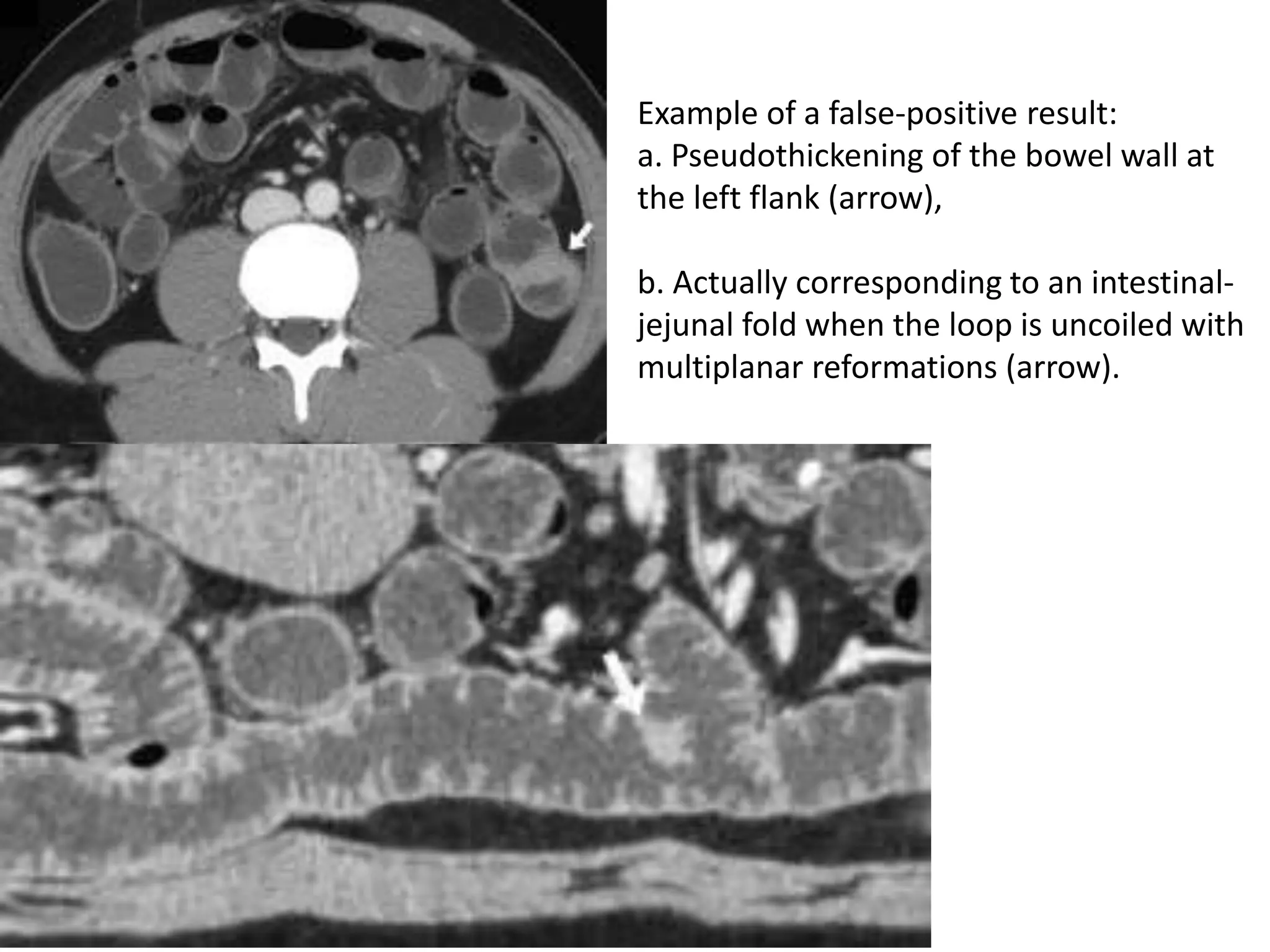 CT Enteroclysis | PPTX