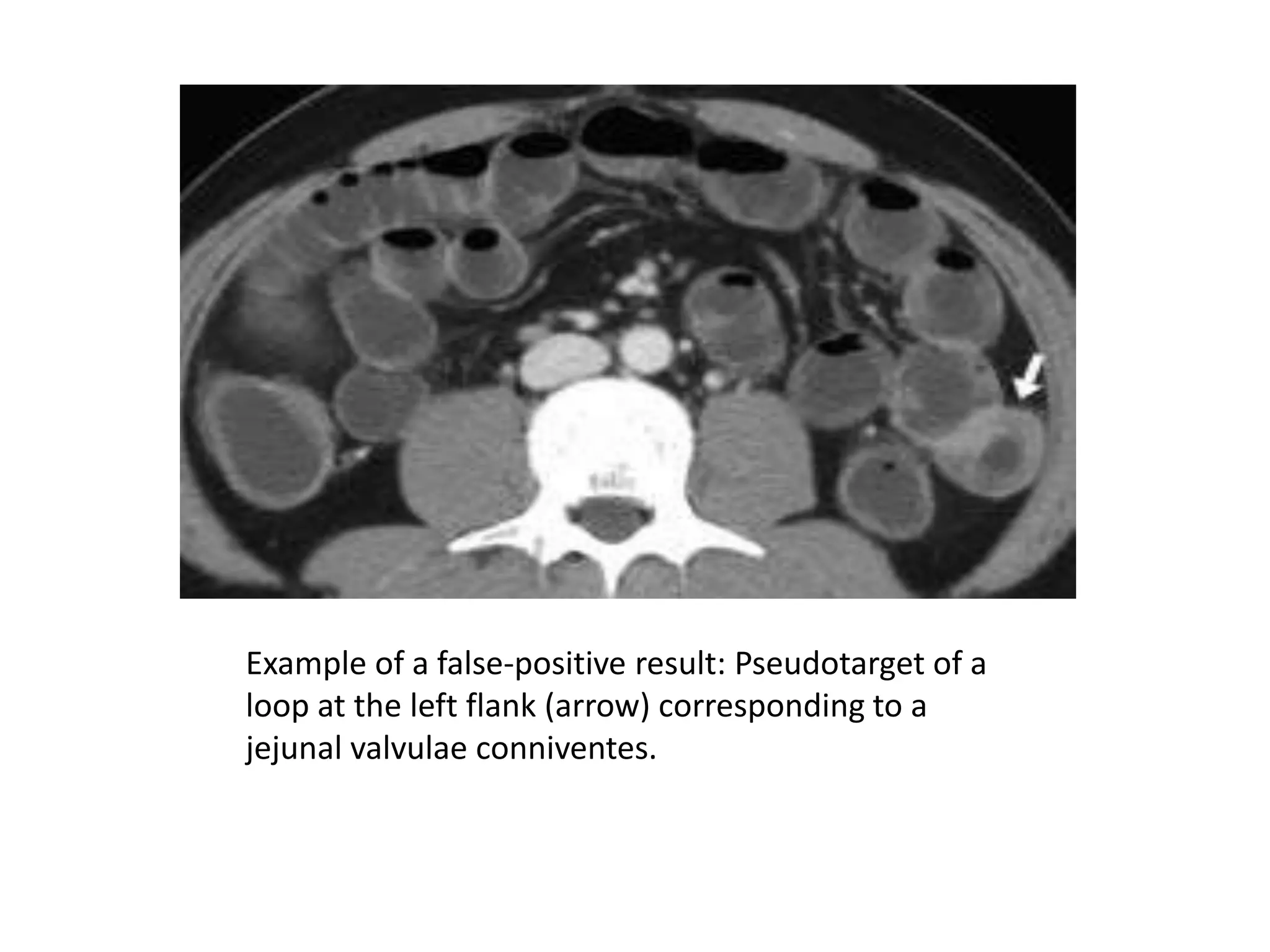 CT Enteroclysis | PPTX