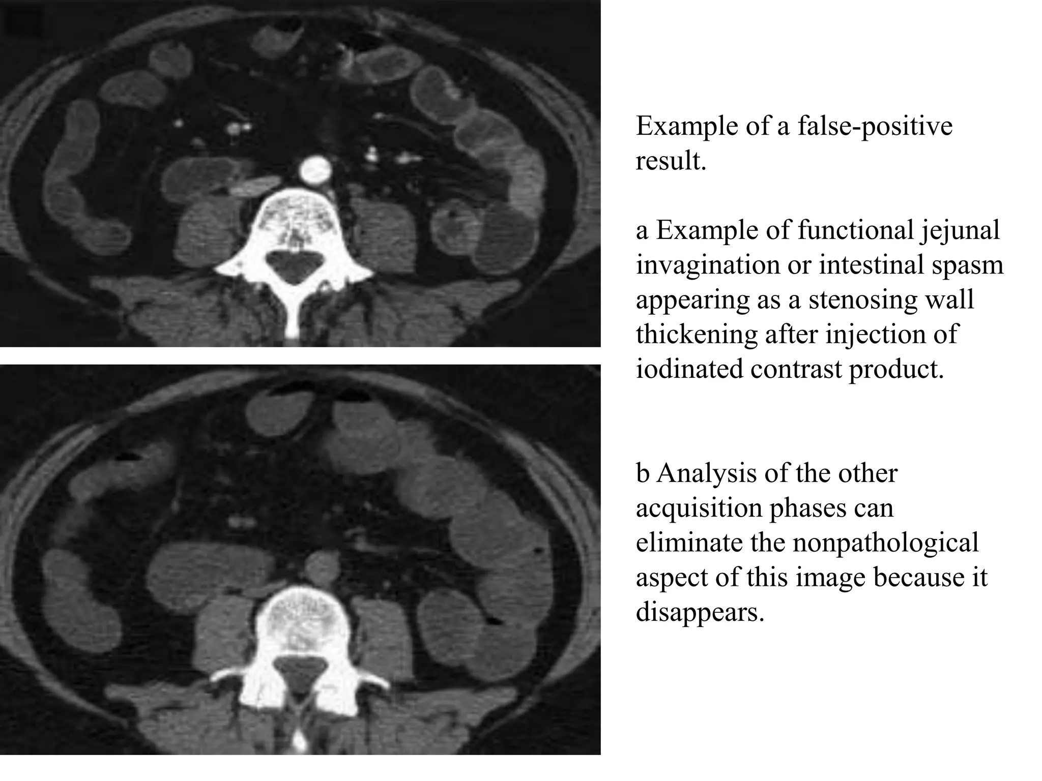 CT Enteroclysis | PPTX