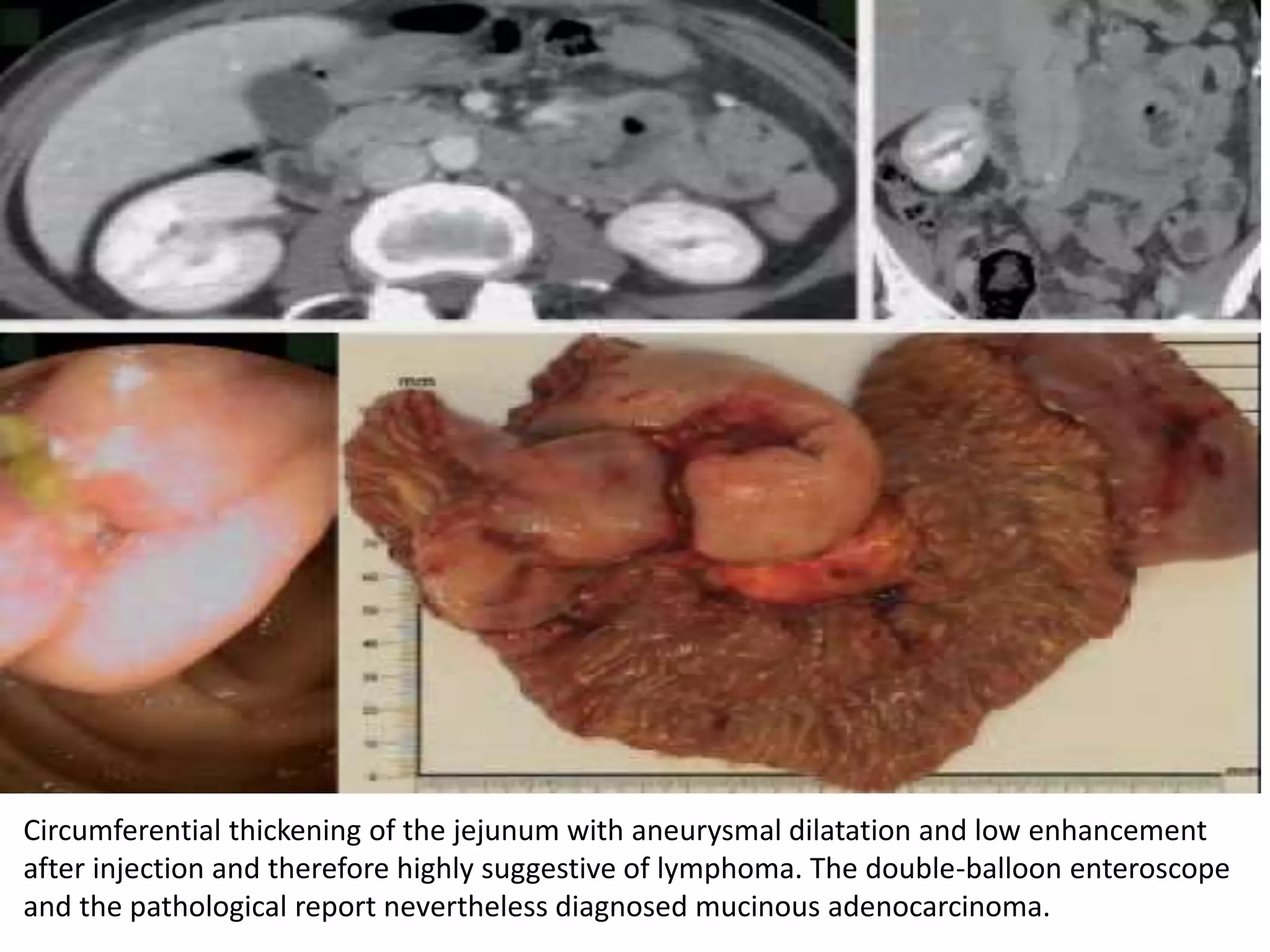 CT Enteroclysis | PPTX