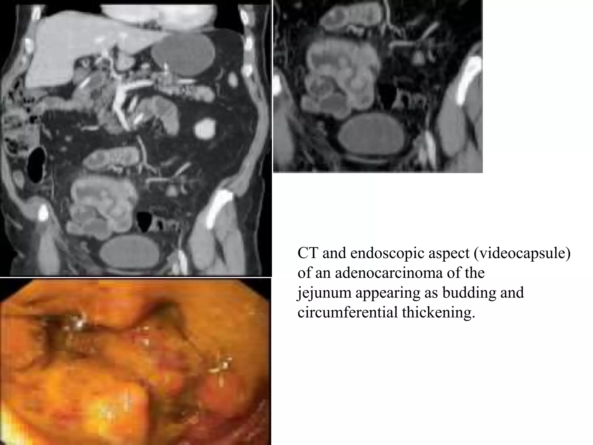 CT Enteroclysis | PPTX