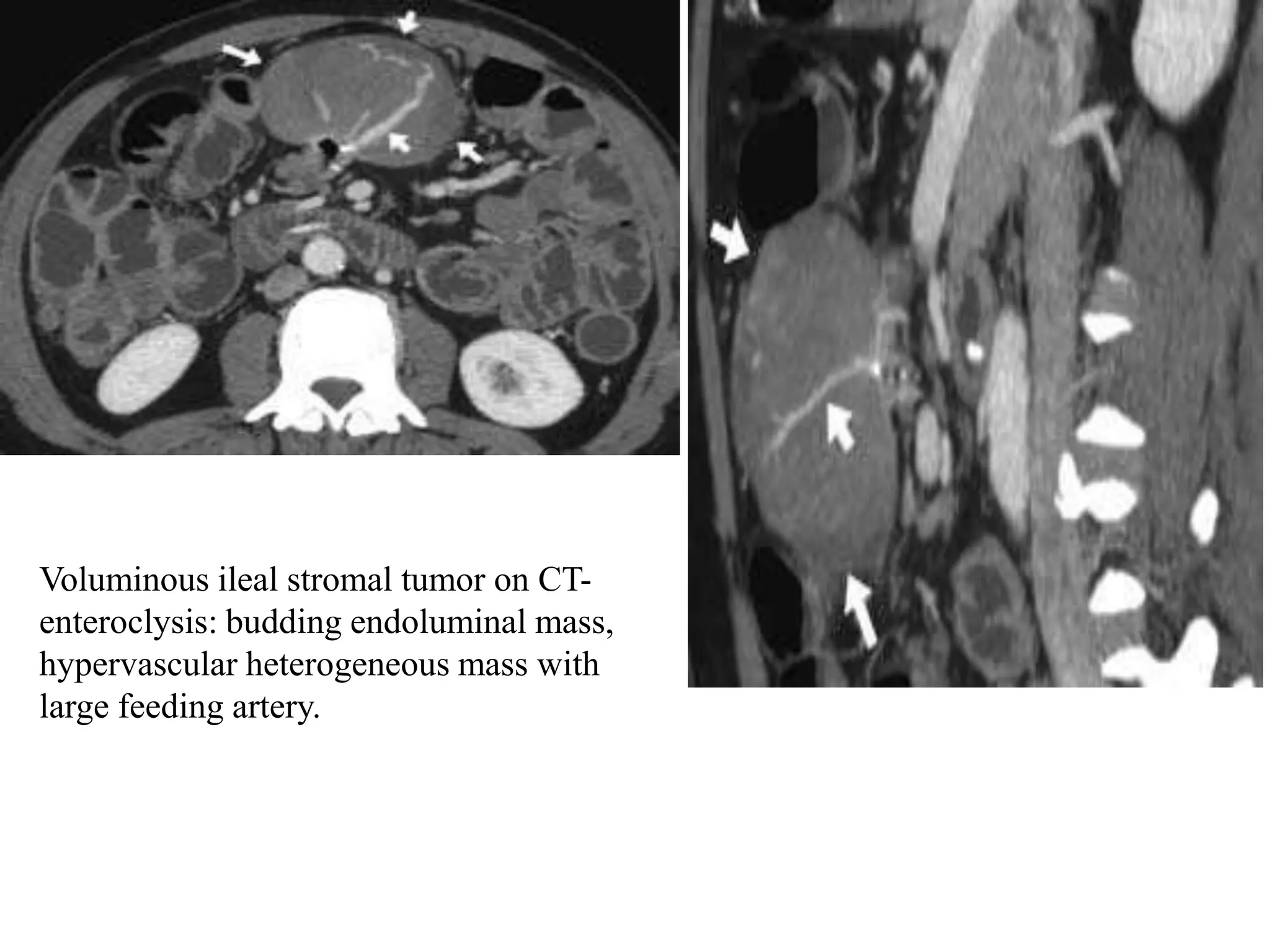 CT Enteroclysis | PPTX