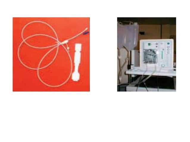 CT Enteroclysis | PPTX