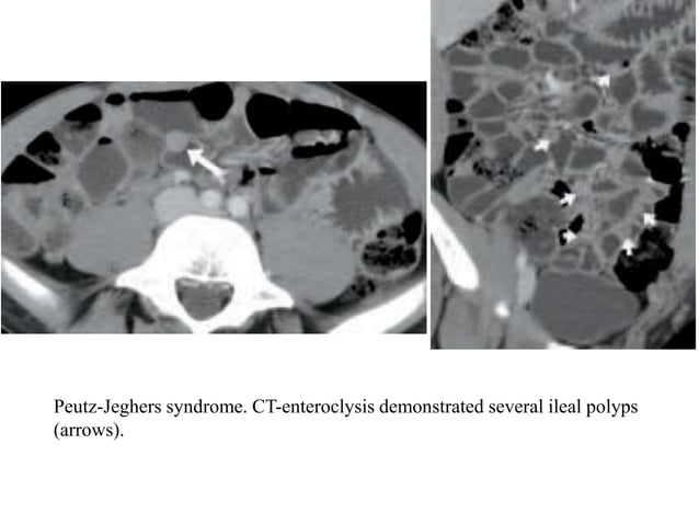 CT Enteroclysis | PPTX