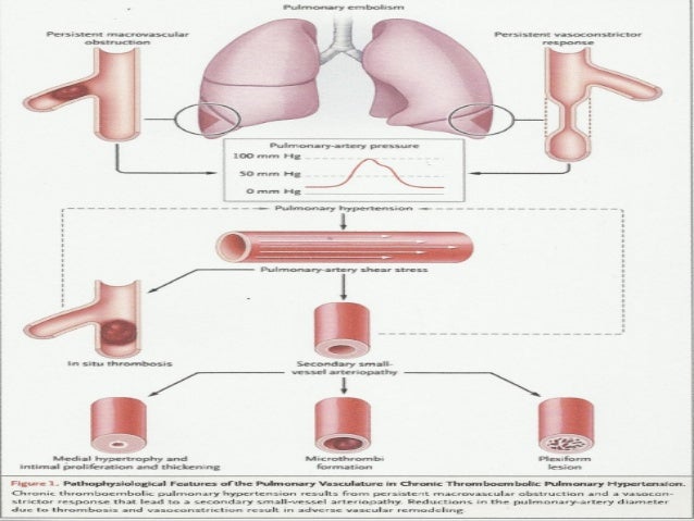 Chronic Thromboembolic Pulmonary artery Hypertension