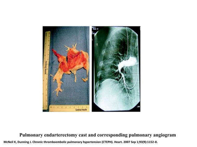Chronic thromboembolic pulmonary hypertension (CTEPH) | PPTX | Heart ...