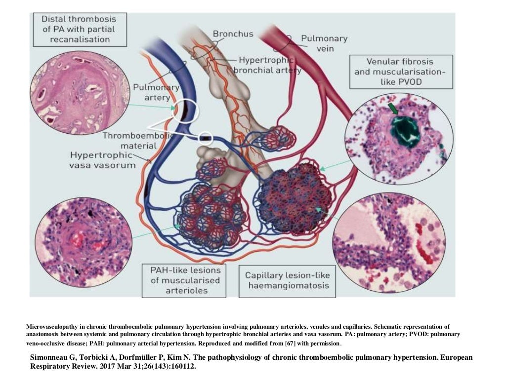 Chronic thromboembolic pulmonary hypertension (CTEPH)