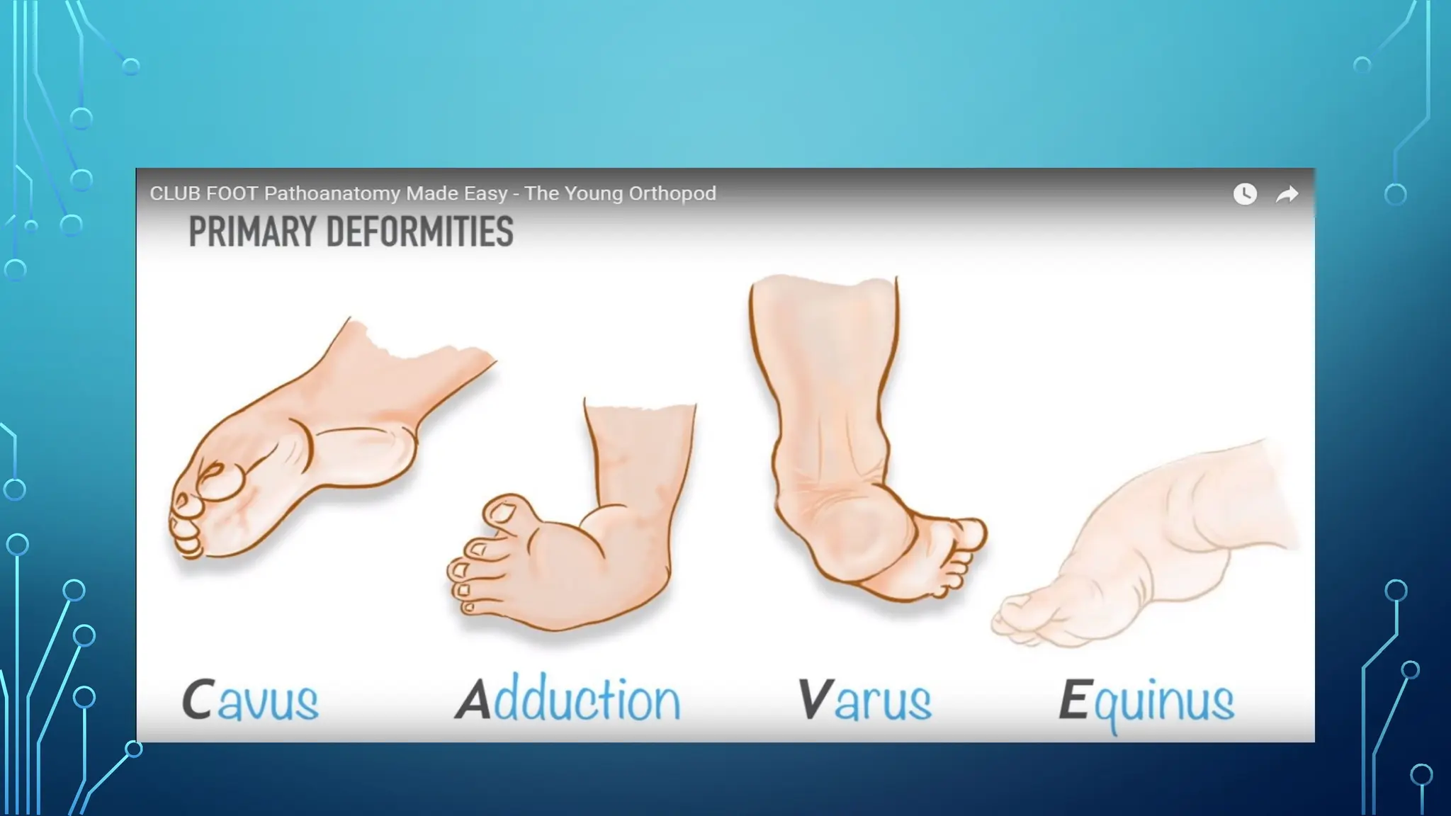 Club foot congenital disorders pediatrics | PPTX