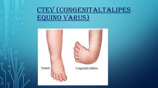 Club foot congenital disorders pediatrics | PPTX