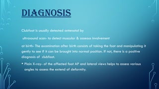 Club foot congenital disorders pediatrics | PPTX