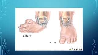 Club foot congenital disorders pediatrics | PPTX
