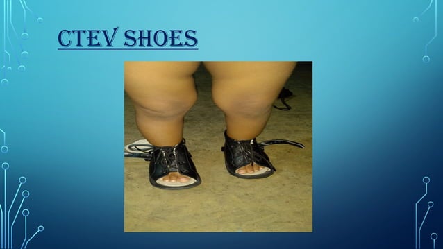 Club foot congenital disorders pediatrics | PPTX | Physical Therapy ...