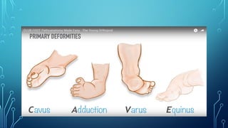 Club foot congenital disorders pediatrics | PPTX