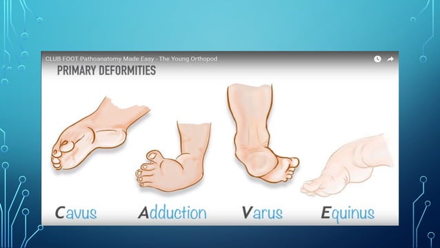 Club foot congenital disorders pediatrics | PPTX | Physical Therapy ...