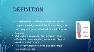 Club foot congenital disorders pediatrics | PPTX