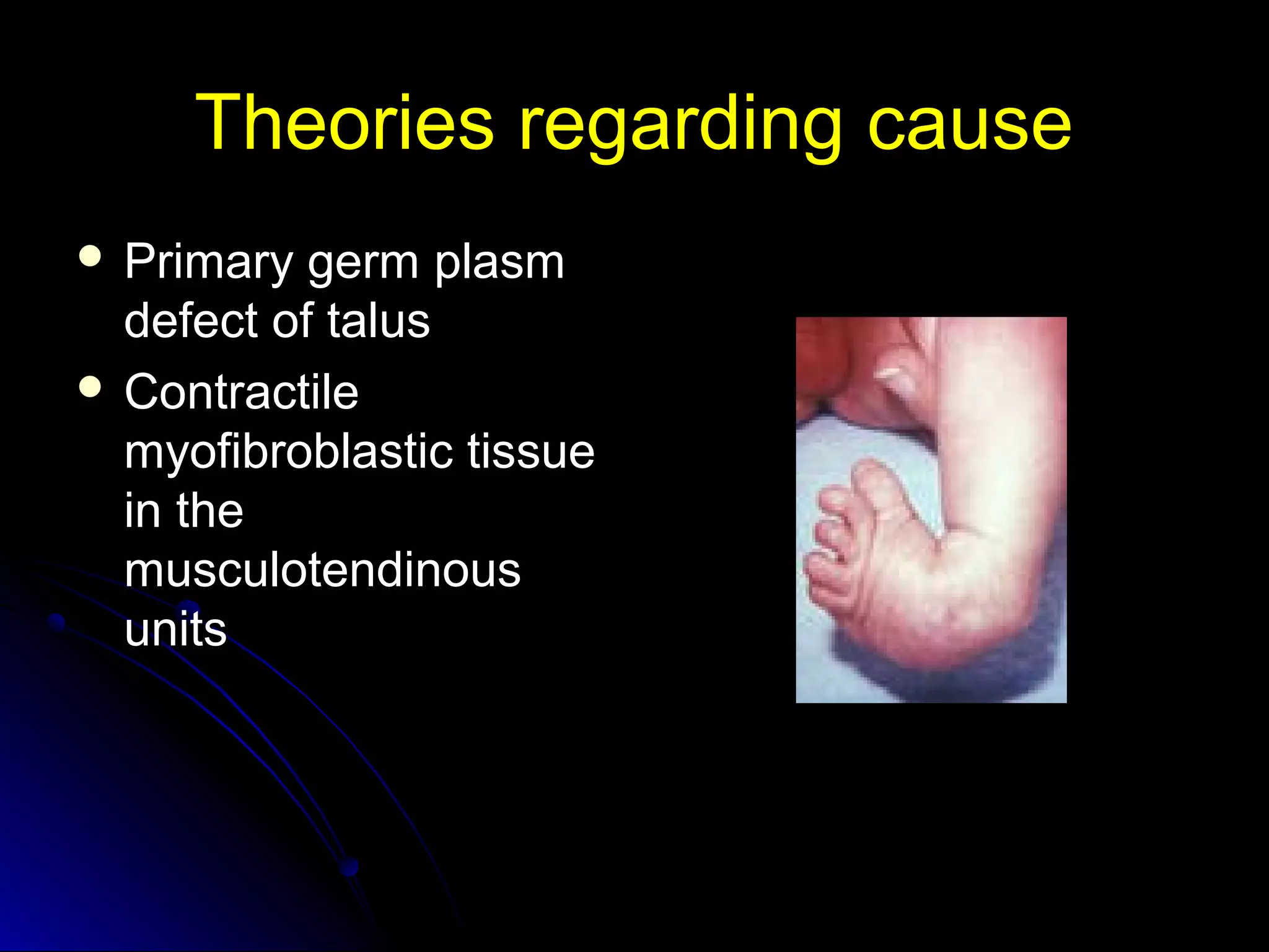 CONGENITAL TALIPES EQUINO VARUS | PPT