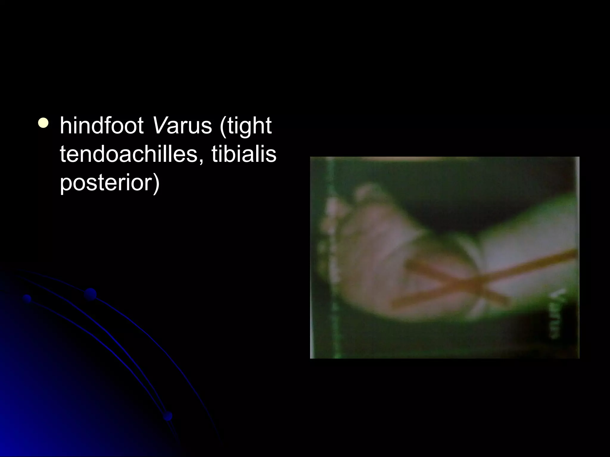 CONGENITAL TALIPES EQUINO VARUS | PPT