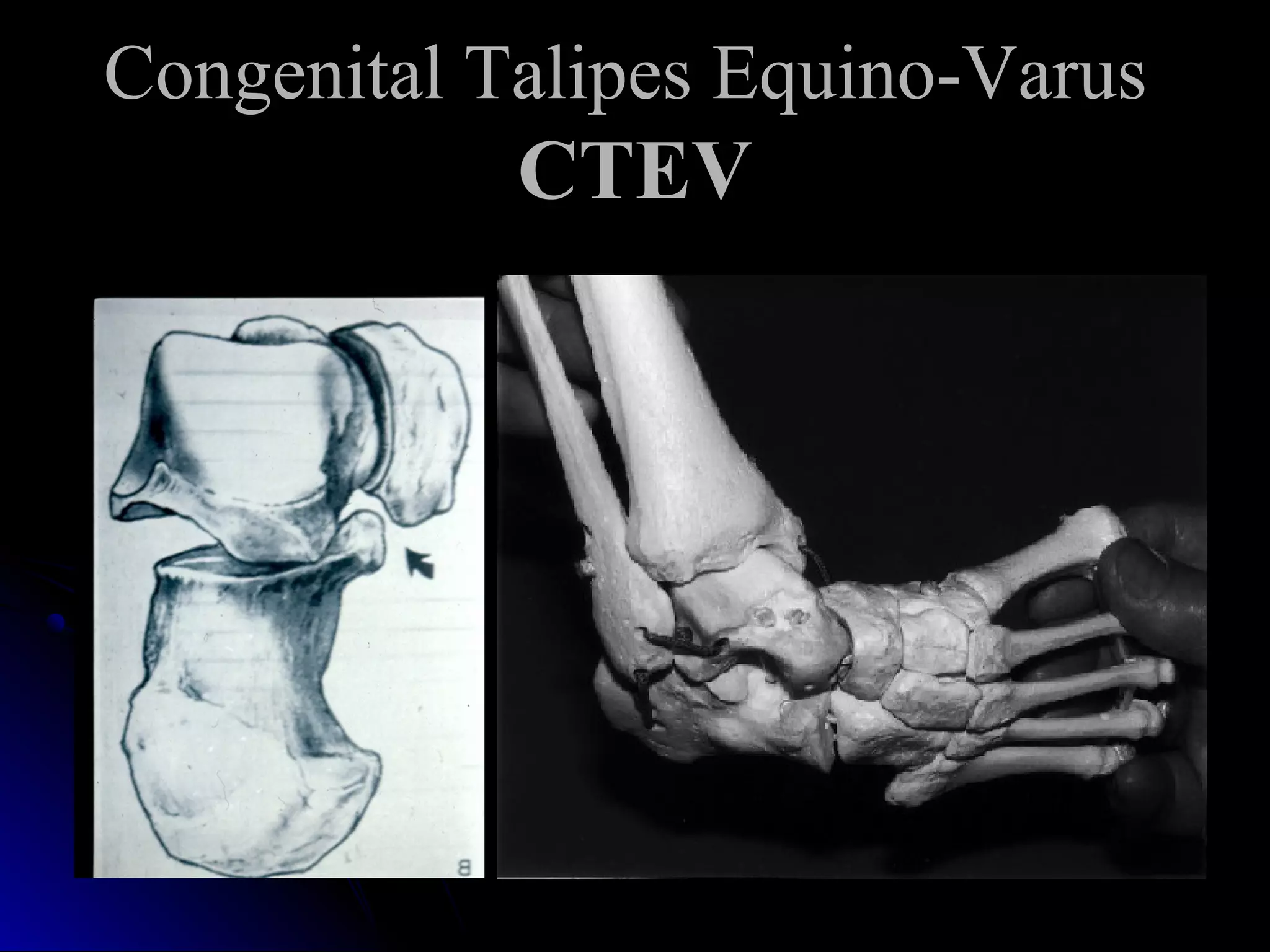 CONGENITAL TALIPES EQUINO VARUS | PPT