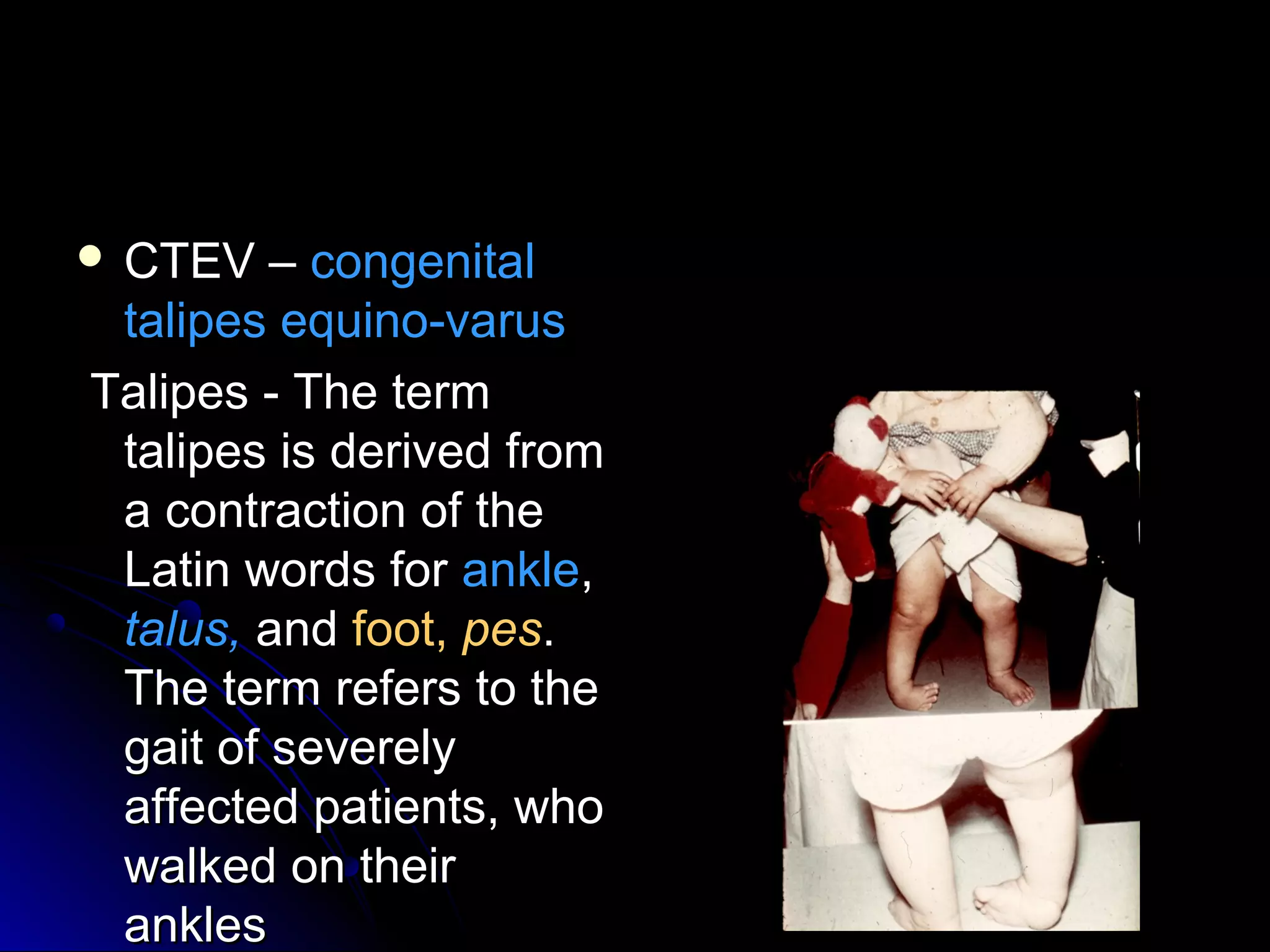 CONGENITAL TALIPES EQUINO VARUS | PPT