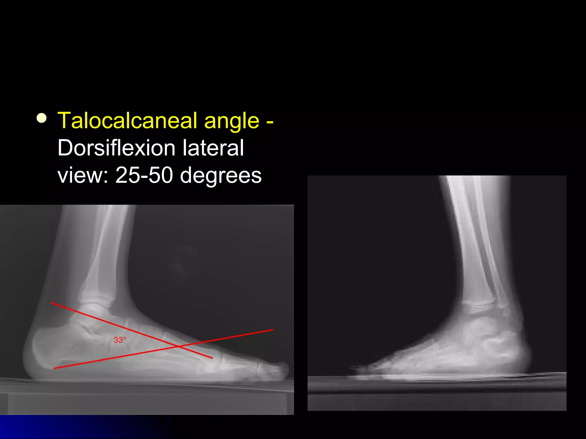 CONGENITAL TALIPES EQUINO VARUS | PPT