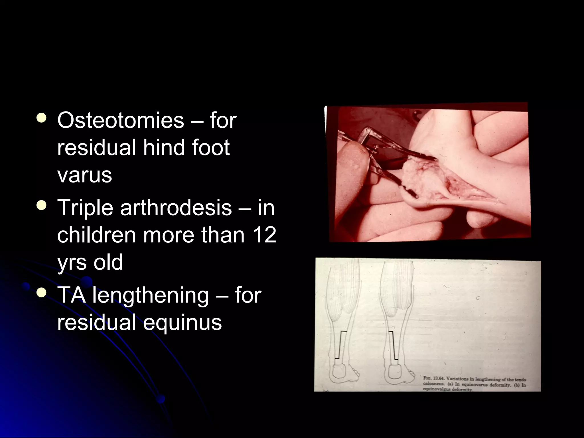 CONGENITAL TALIPES EQUINO VARUS | PPT
