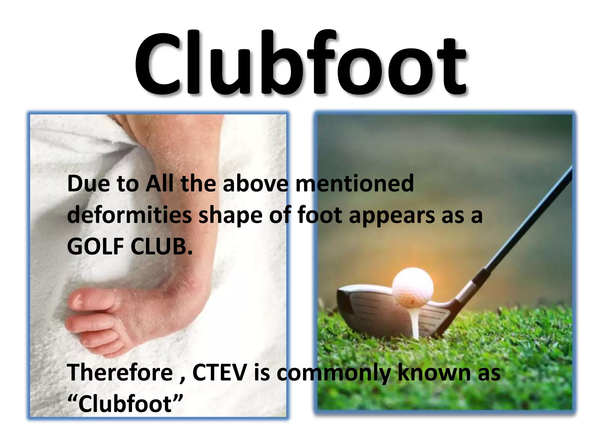 Congenital Talipes Equino Varus (CTEV) | PPT