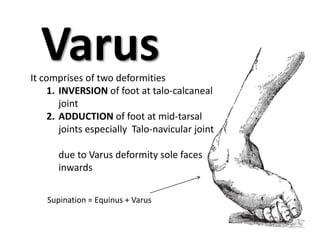 Congenital Talipes Equino Varus (CTEV) | PPTX | Foot Health | Diseases ...