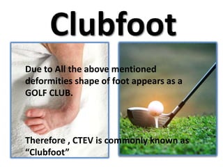 Congenital Talipes Equino Varus (CTEV) | PPTX | Foot Health | Diseases ...
