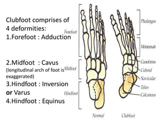 Congenital Talipes Equino Varus (CTEV) | PPTX | Foot Health | Diseases ...