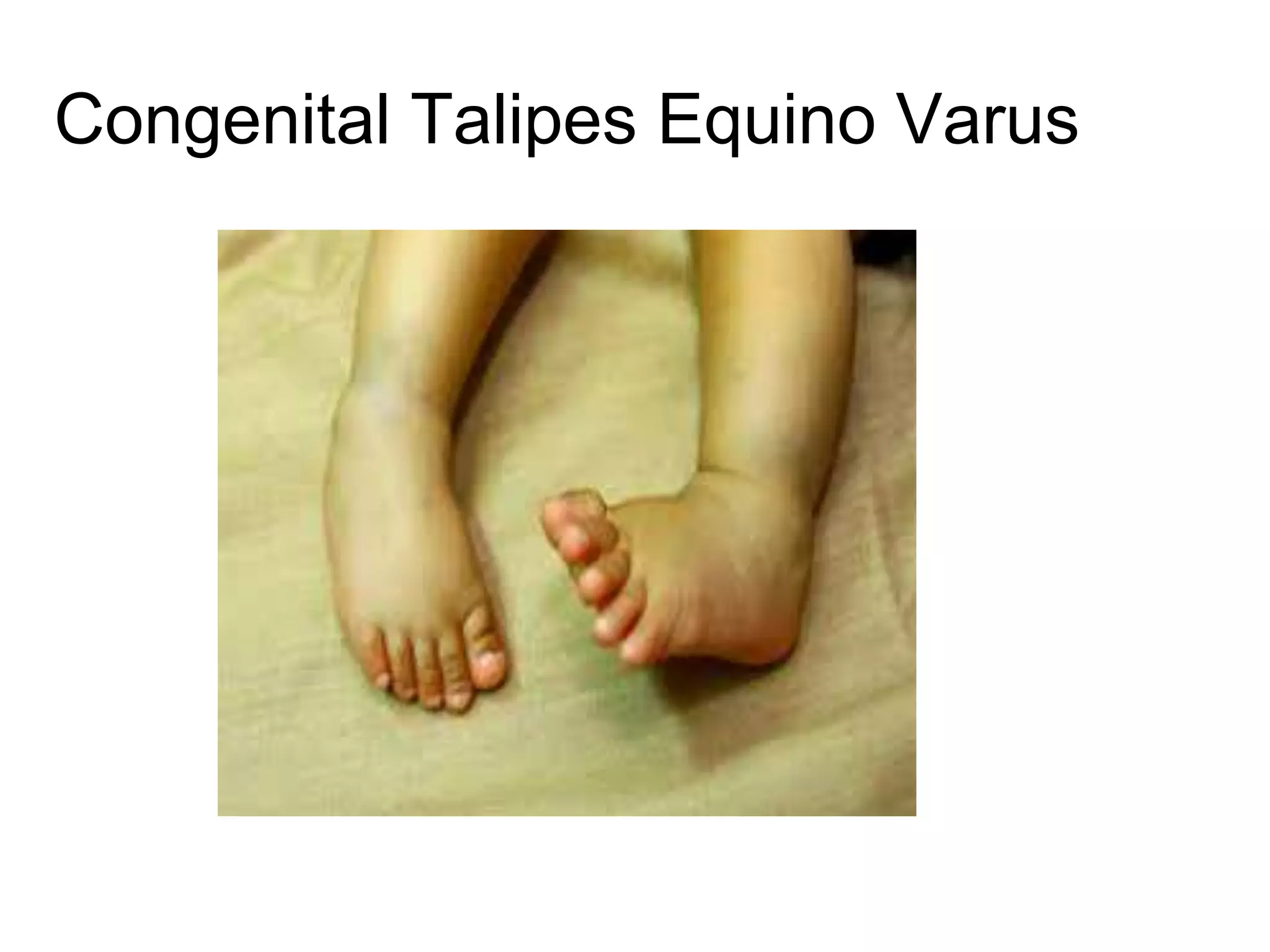 CTEV ( Congenital Talipes Equina Varus)- A short Review | PPT