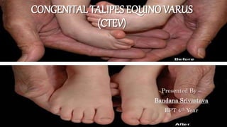 CONGENITAL TALIPES EQUINO VARUS (CTEV) | PPTX
