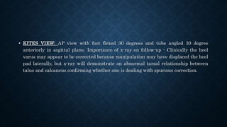 CONGENITAL TALIPES EQUINO VARUS (CTEV) | PPTX