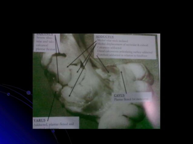 Congenital telipus equino varus, ctev , orthopaedic | PPT