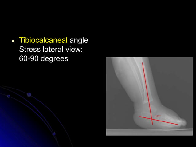 Congenital telipus equino varus, ctev , orthopaedic | PPT