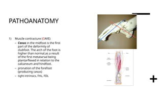Basic of CTEV and Ponsetti casting .pptx