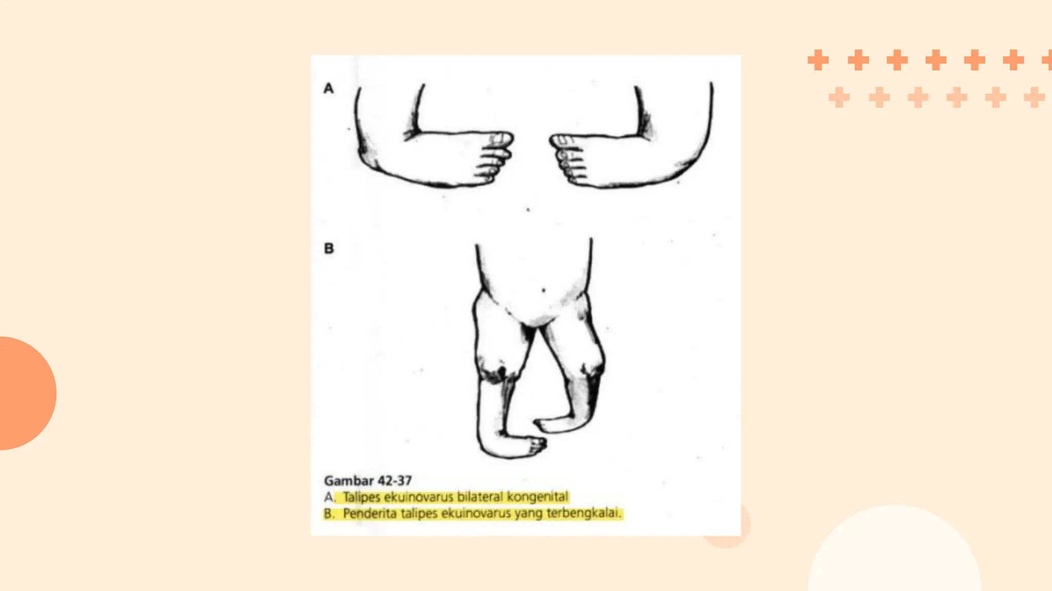 CTEV.pdf congenital tallipes equinovarus | PDF