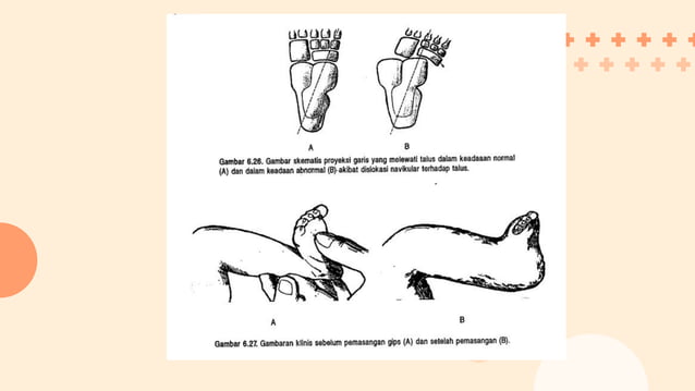 CTEV.pdf congenital tallipes equinovarus | PPT