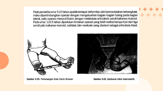 CTEV.pdf congenital tallipes equinovarus | PPT