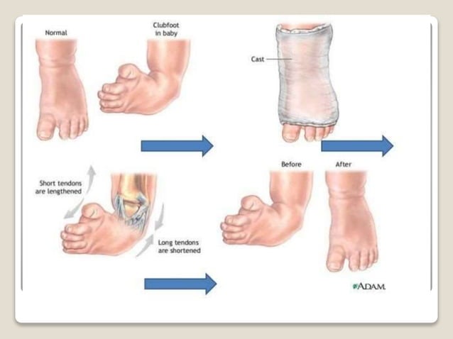 Congenital Talipes Equino Varus | PPT