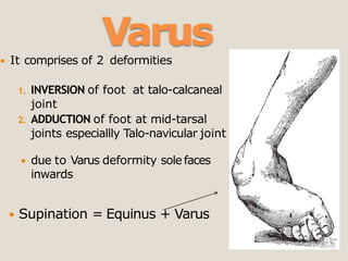 Congenital Talipes Equino Varus | PPTX