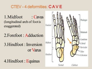 Congenital Talipes Equino Varus | PPTX