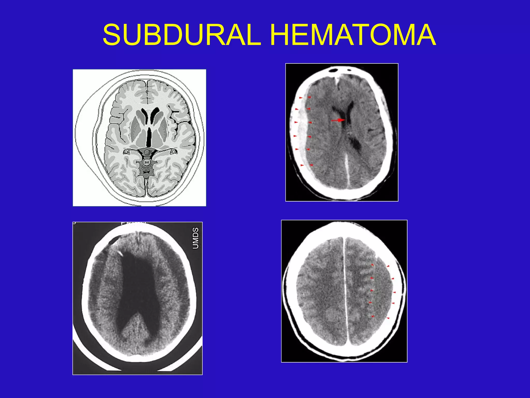 Head Trauma Ct Evaluation | PPT