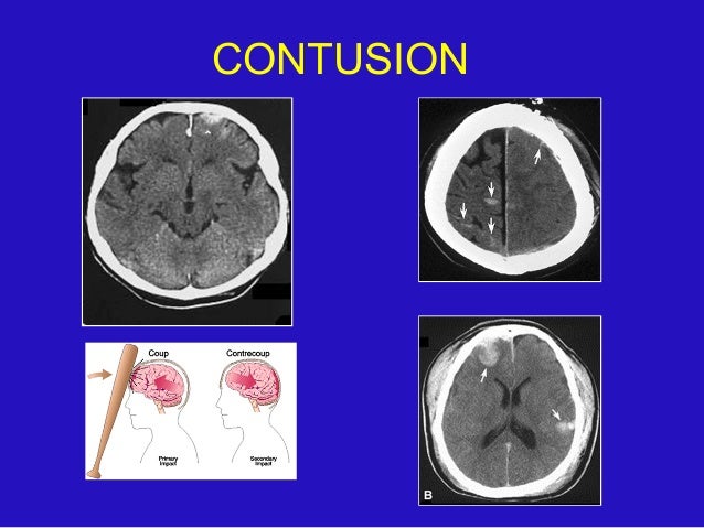 Head Trauma Ct Evaluation