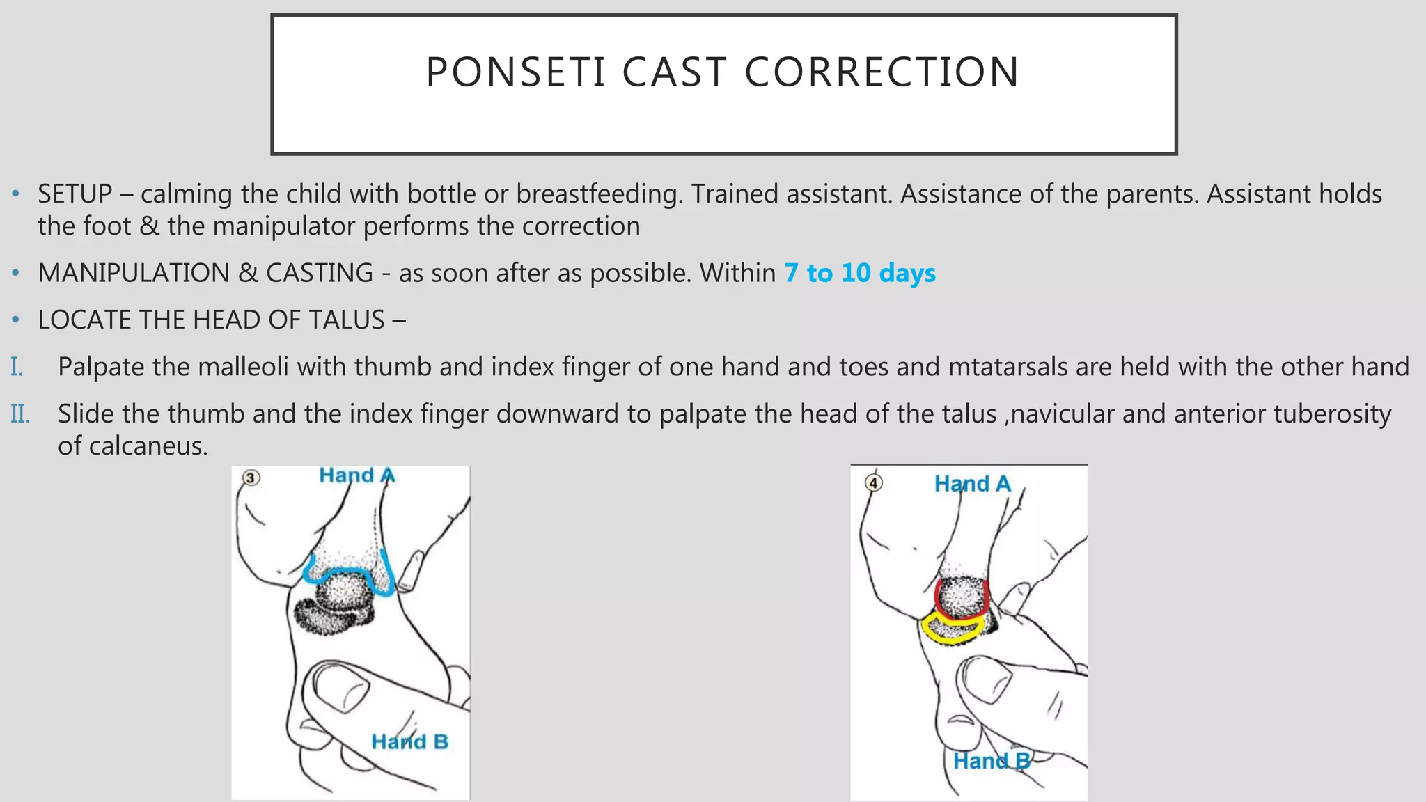Ctev assessment & ponseti technique | PPTX