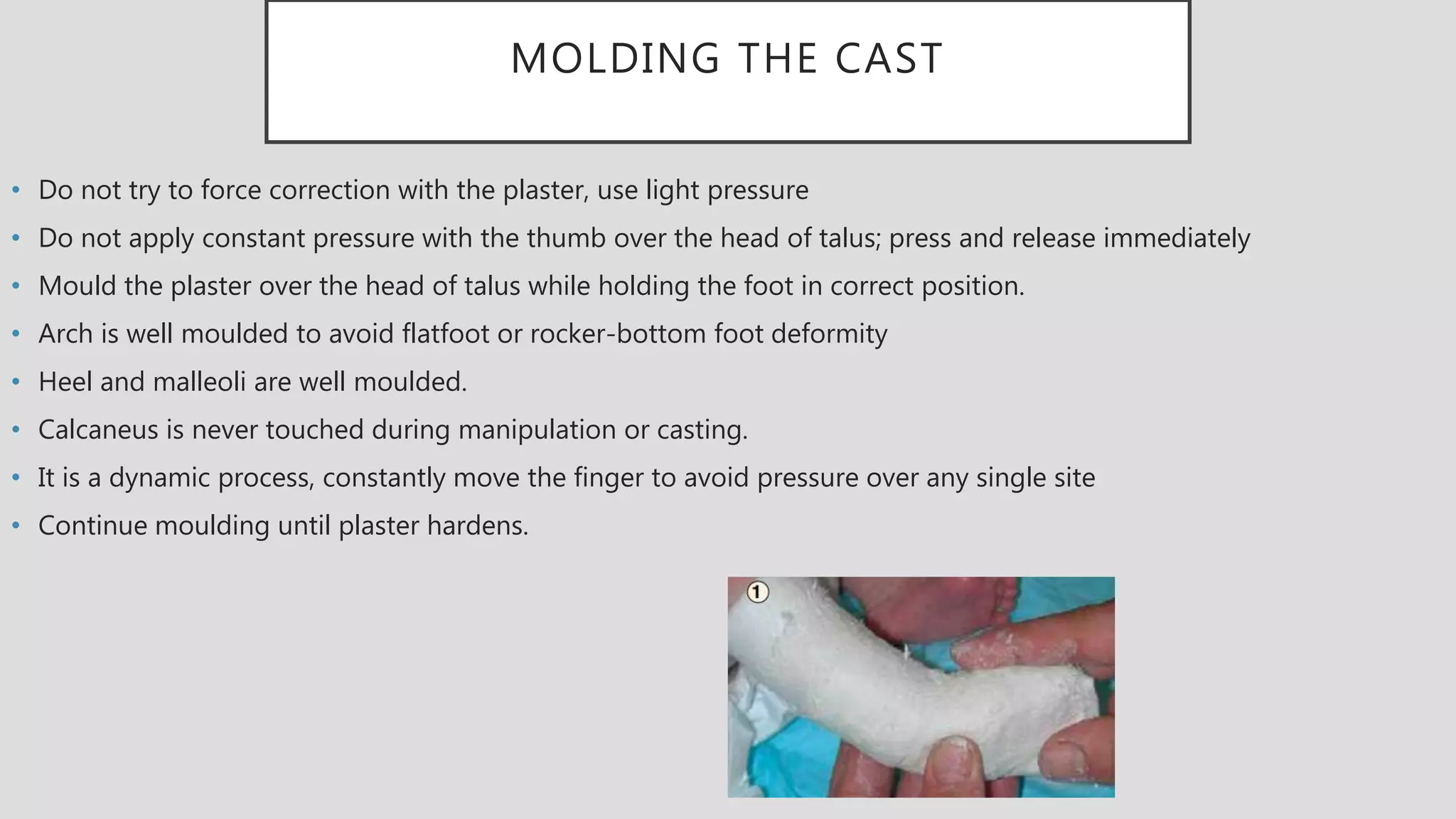 Ctev assessment & ponseti technique | PPTX
