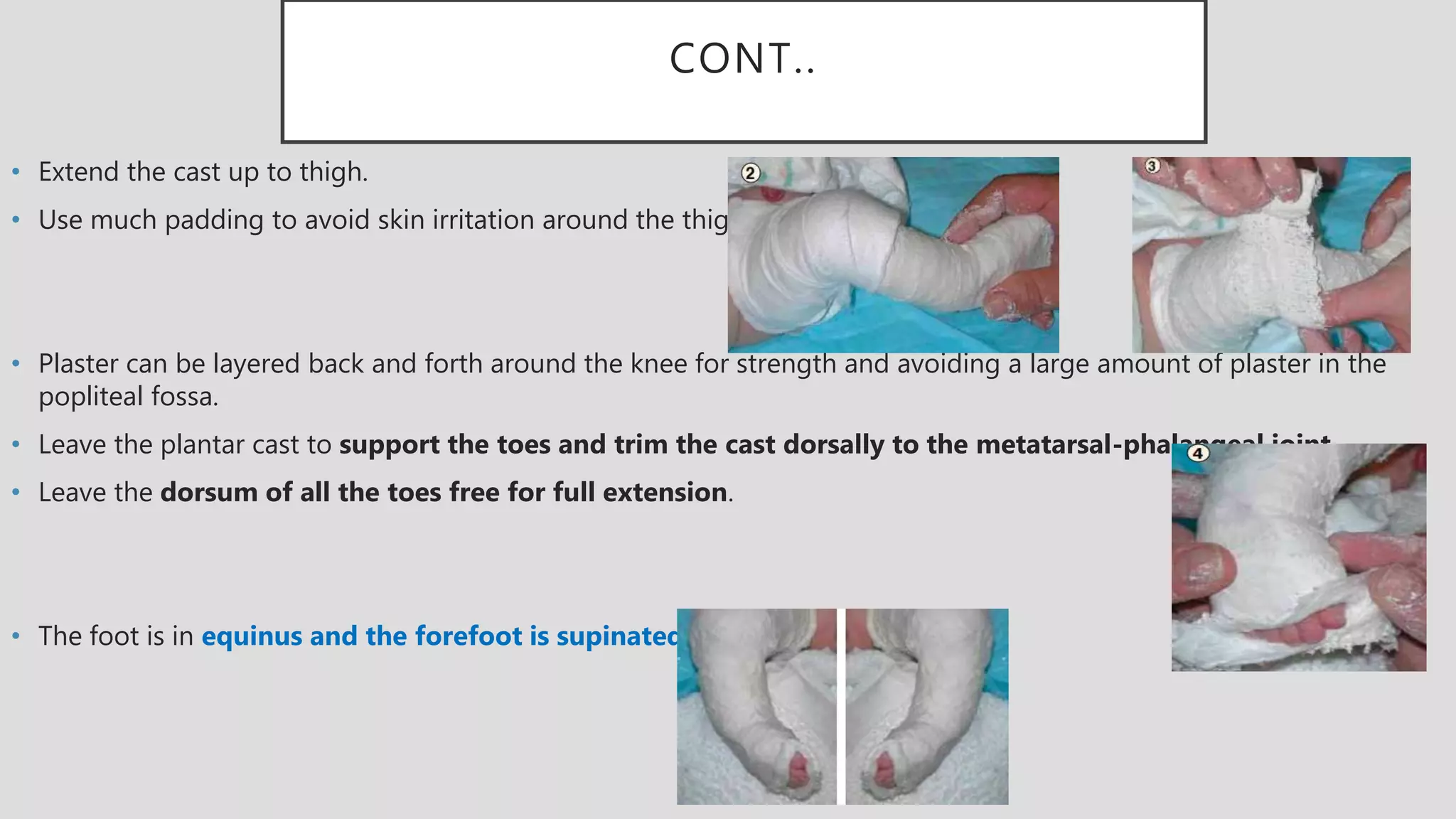 Ctev assessment & ponseti technique | PPTX