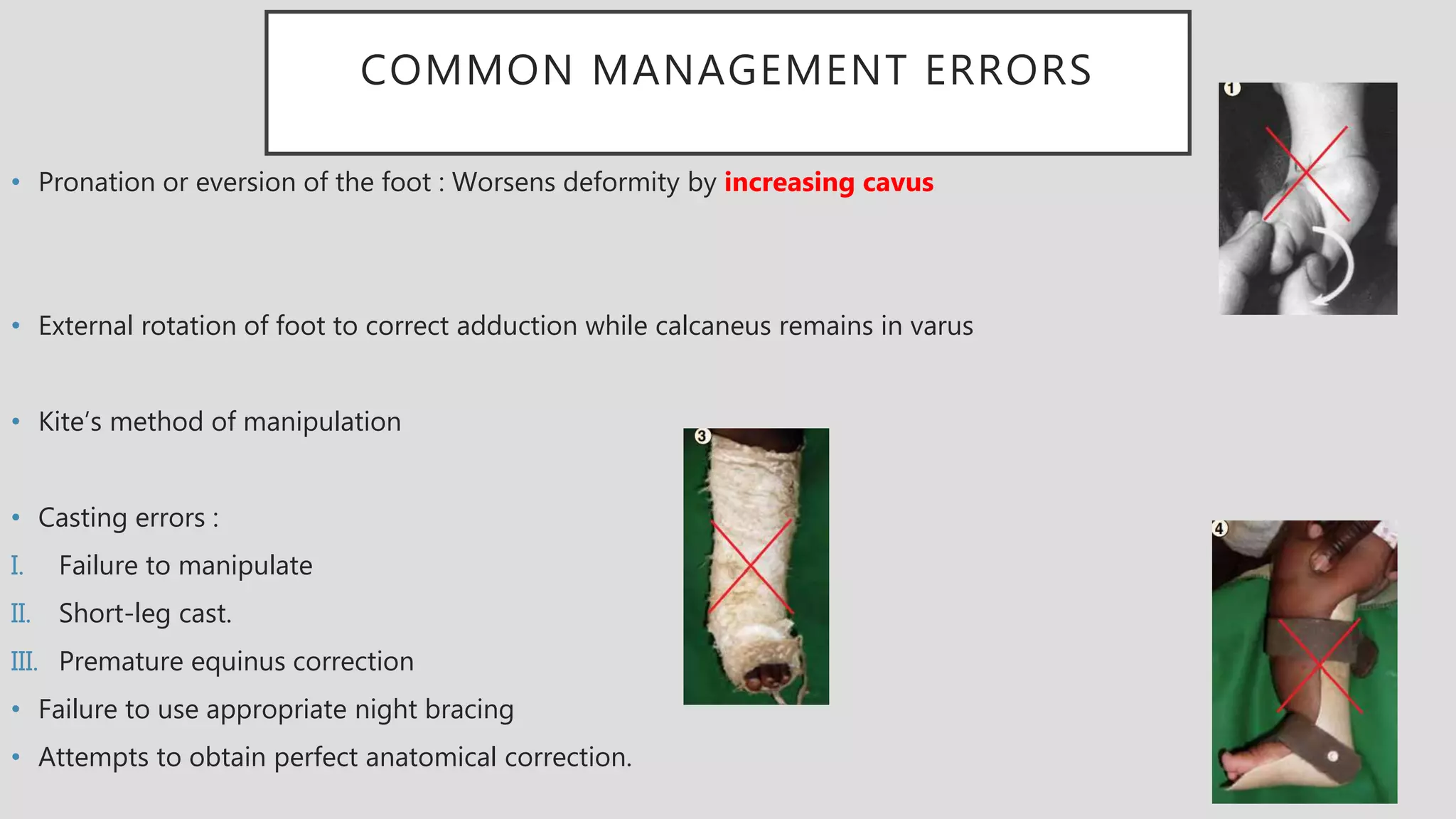 Ctev assessment & ponseti technique | PPTX